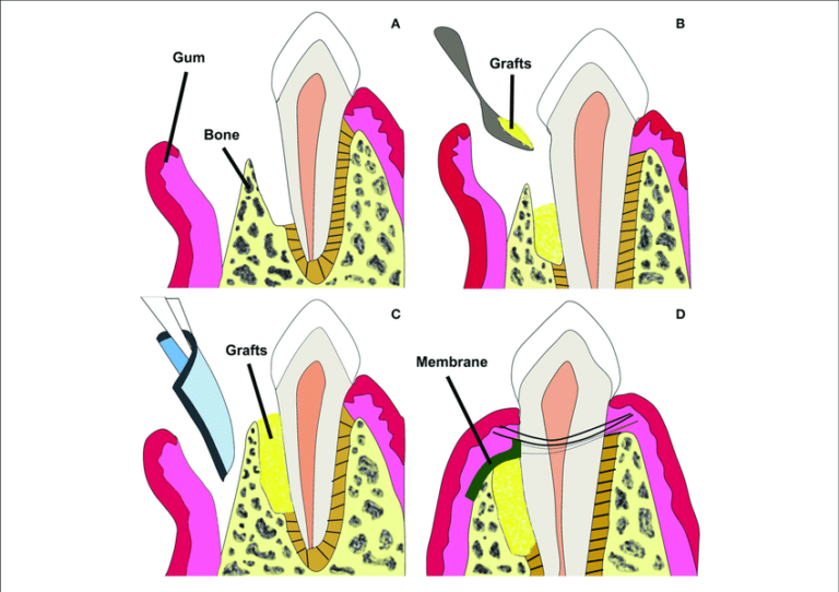 GTR & GBR Surgeries in Aurangabad | Maharashtra