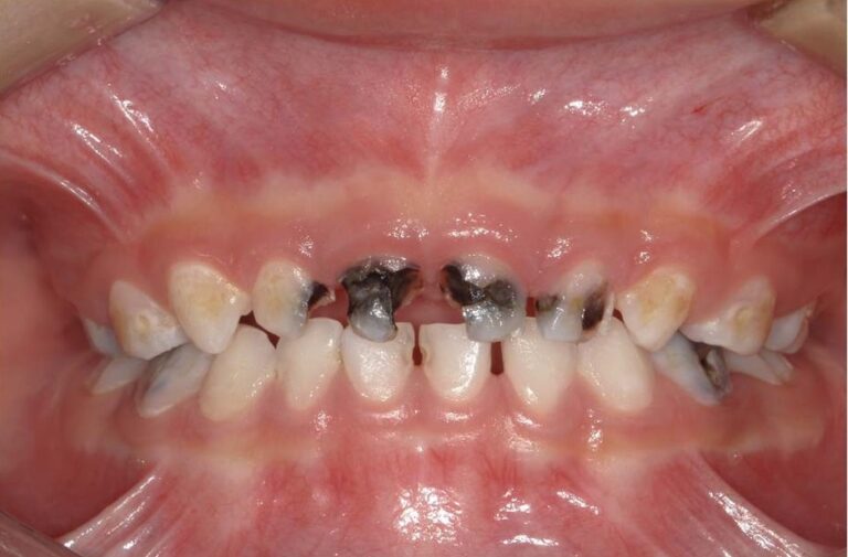 Dental Caries Management in Children and Adults