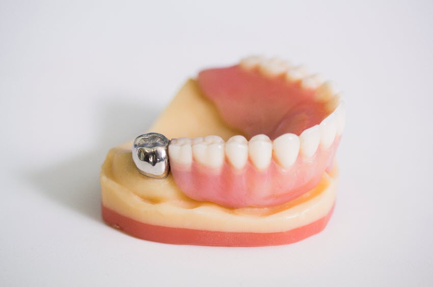 Preformed Crown Placement at Dr. Changule's Face Clinic