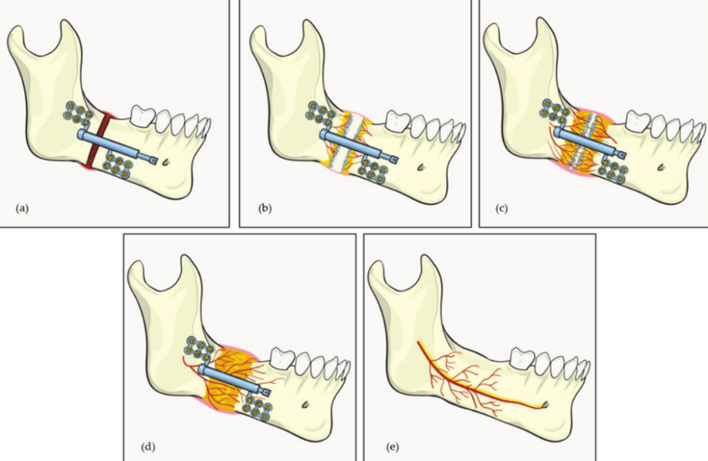 Distraction Osteogenesis | Dr. Changule's Face Clinic